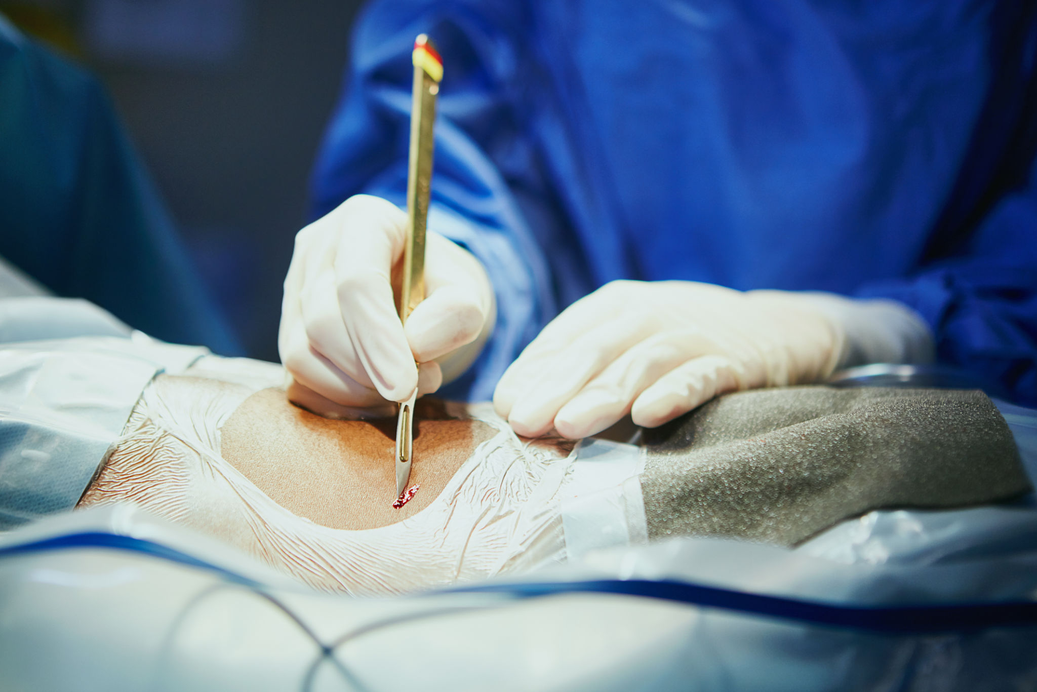 Incisions in Oral Surgery : All You Need to know - Study With The Dentist
